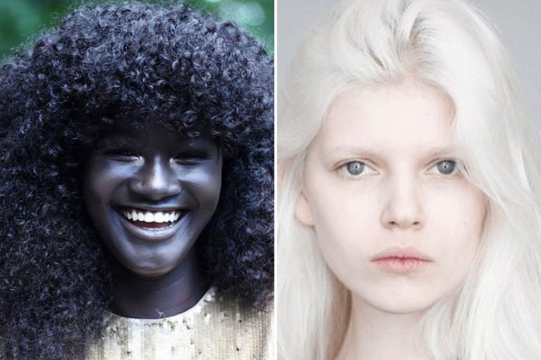 20 People With Unique Genetic Traits That Are Hard to Forget - ReadBakery